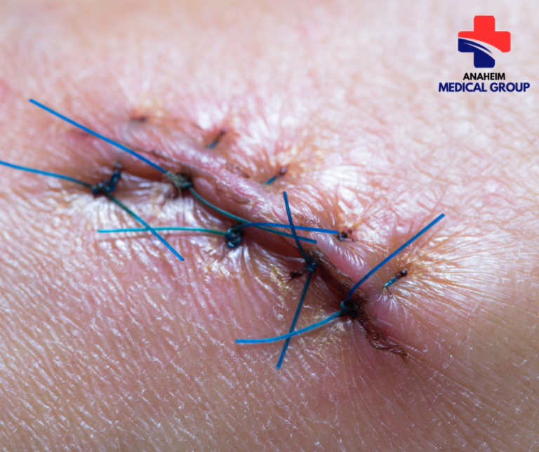 Minor Cuts And Wounds In Anaheim: Walk In Now For Help
